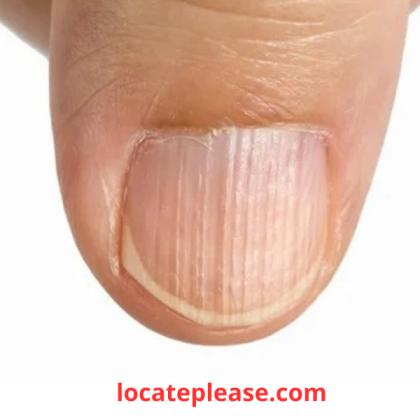 Doctor Explains What It Means If You Have Ridges on Your Fingernails ...